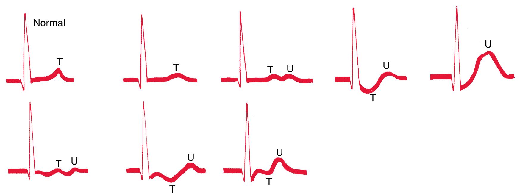 -5. the ecg patterns that may be seen with hypokalemia range