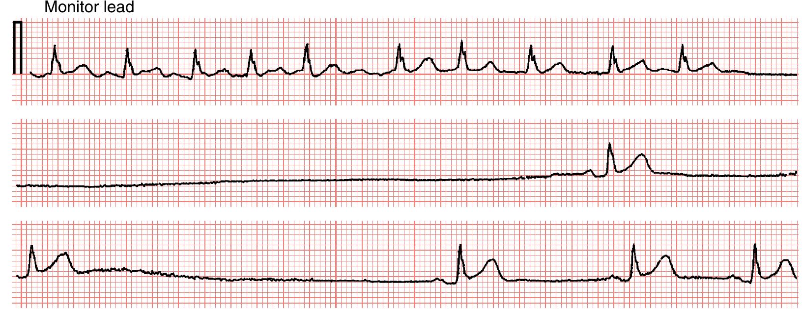 -8. sinus arrest following abrupt cessation of paroxysmal