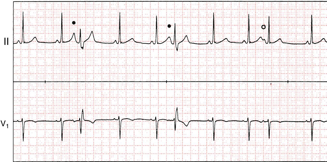 -5. ecg shows sinus rhythm with three atrial premature