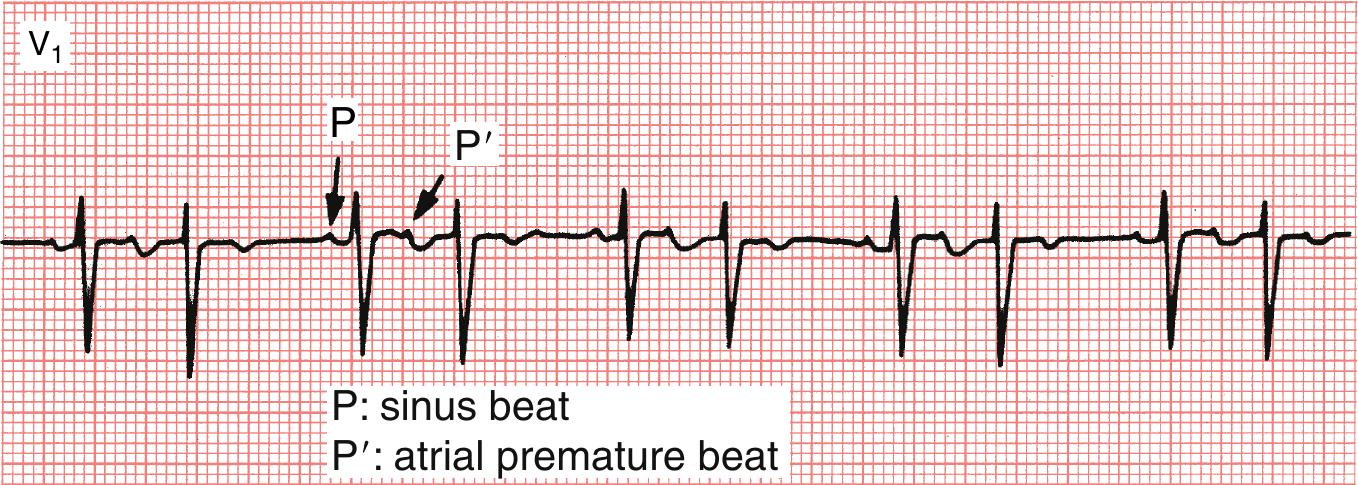 -3. a, sinus rhythm with atrial ectopy. note the atrial