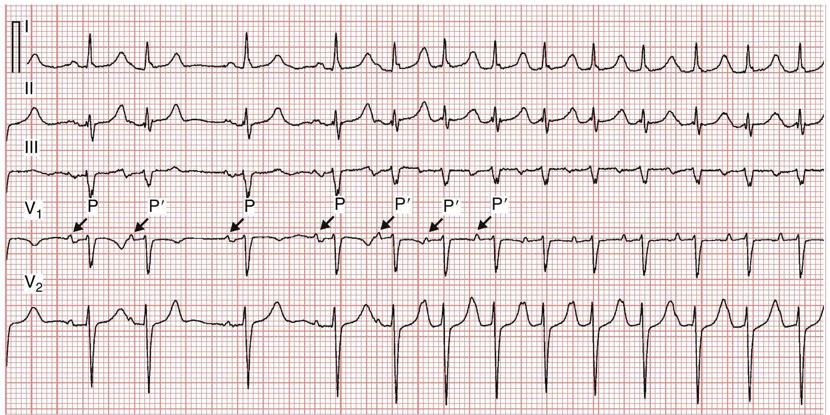 -8. atrial tachycardia (at). p wave (arrow) indicates a