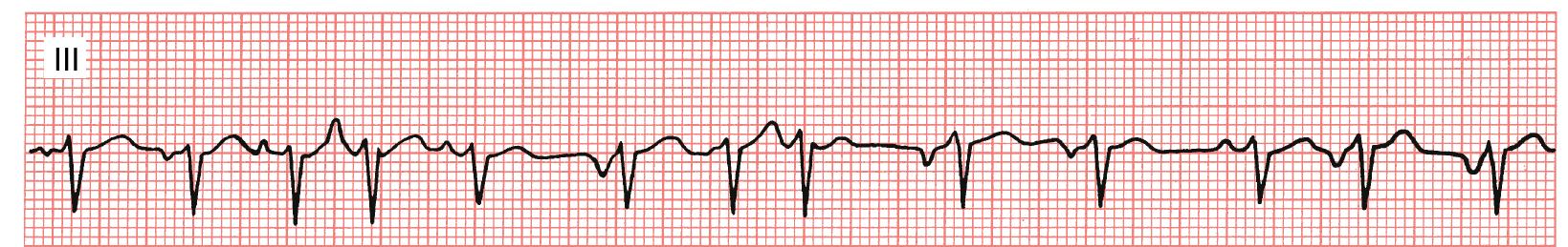 -11. multifocal atrial tachycardia. note the rapidly