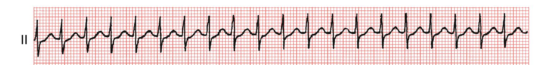 -13. atrioventricular nodal reentrant tachycardia (avnrt).