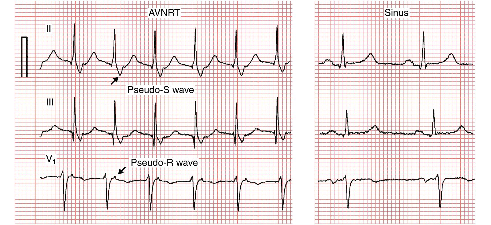 -14. pseudo-s waves (leads ii, iii) and pseudo-r’ waves