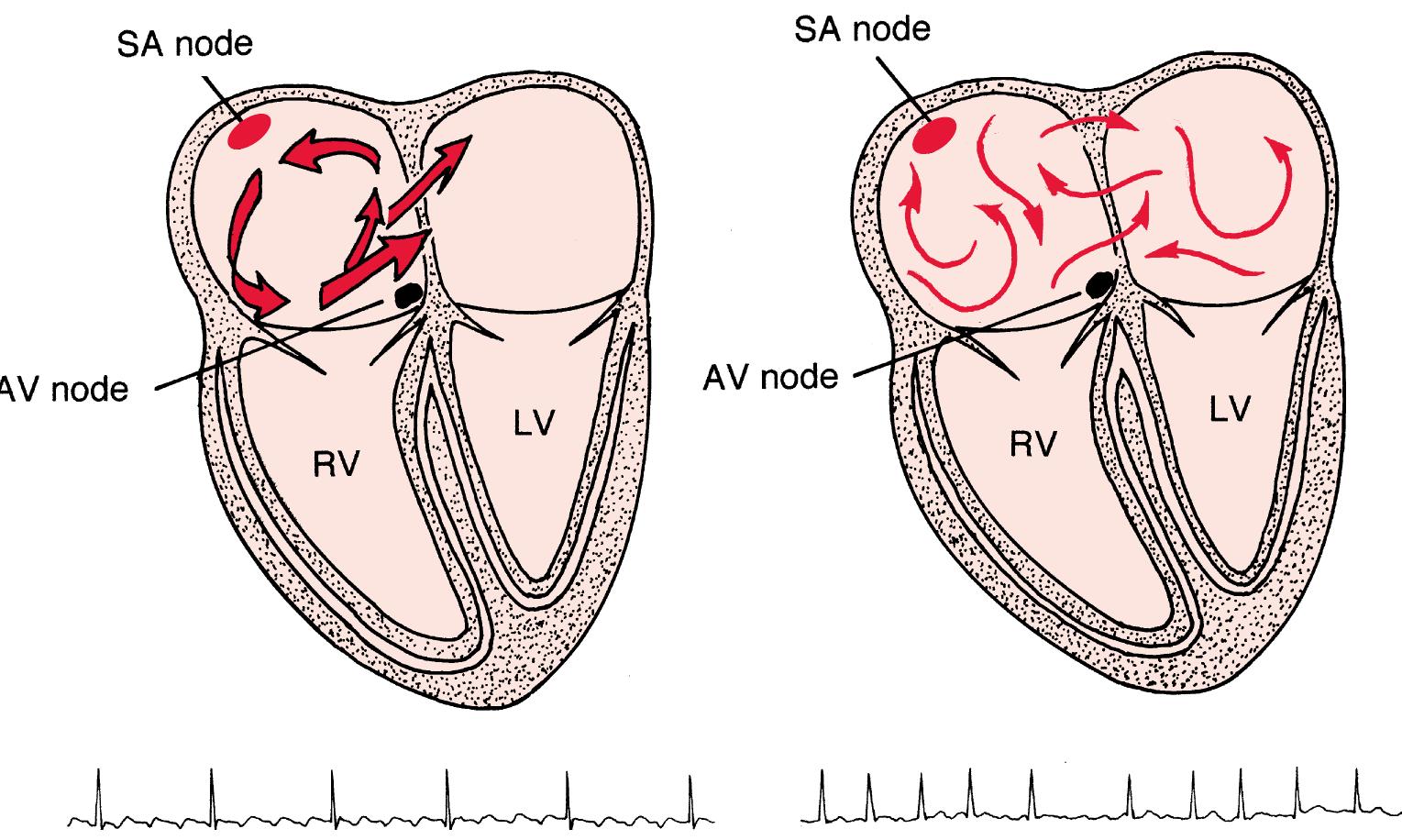 -1. diagram comparing mechanisms of atrial flutter and
