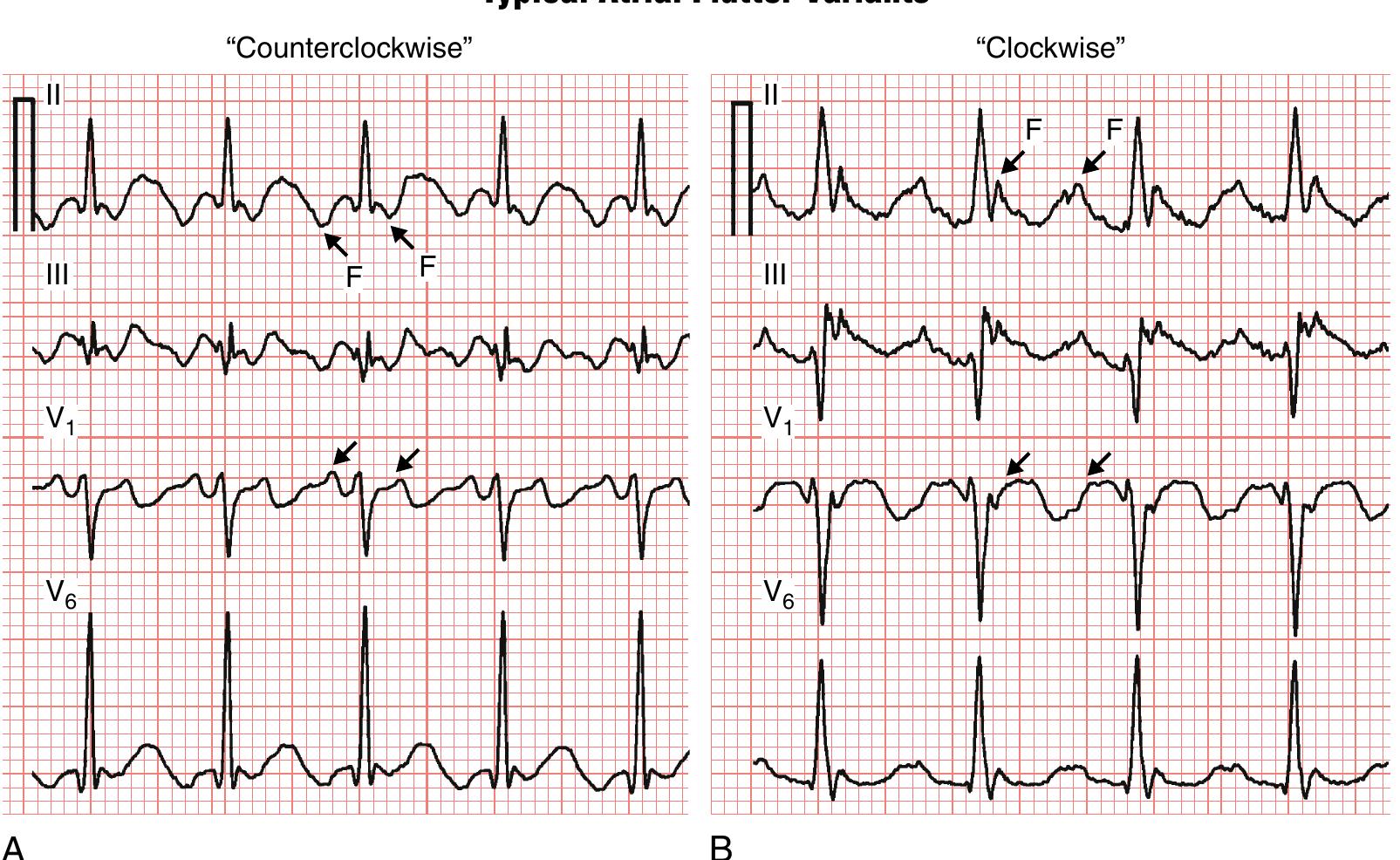 -2. a, typical atrial flutter most commonly involves a