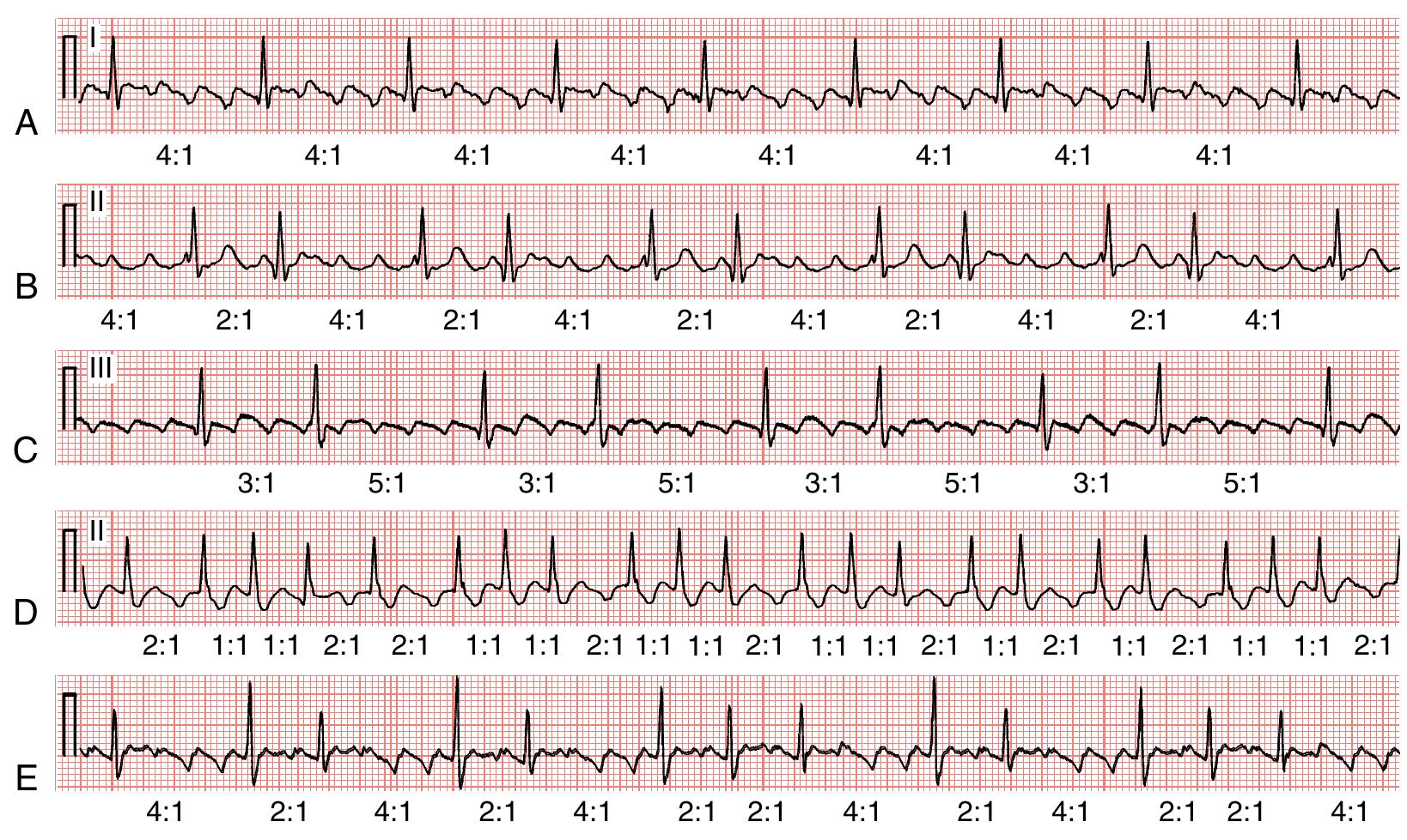-4. atrial flutter from different patients (a through e)