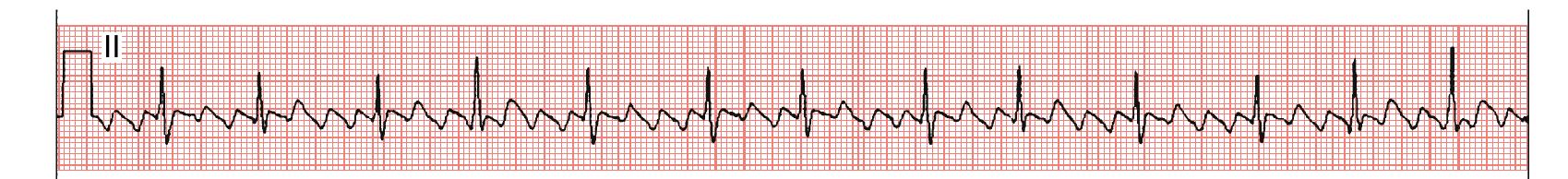 -5. wich atrial flutter, the ventricular response may be