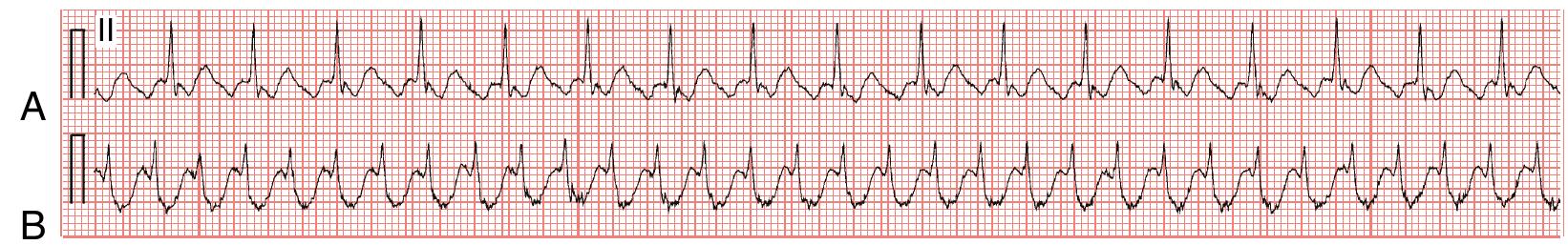 Atrial flutter with 2:1 and 1:1 av conduction figure 15-6.
