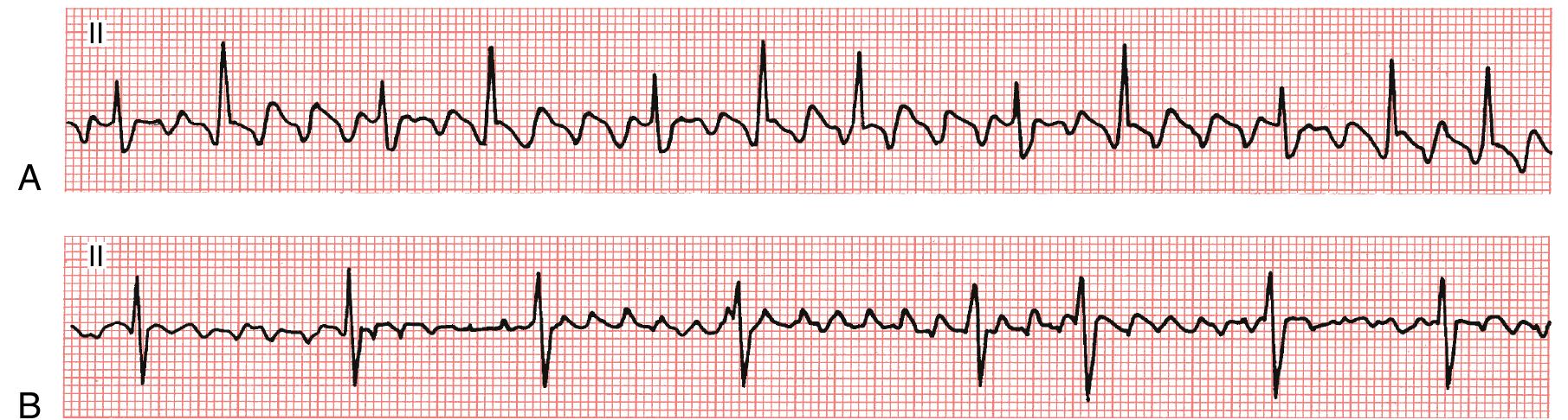 -7. atrial flutter with variable block (a) and coarse atrial
