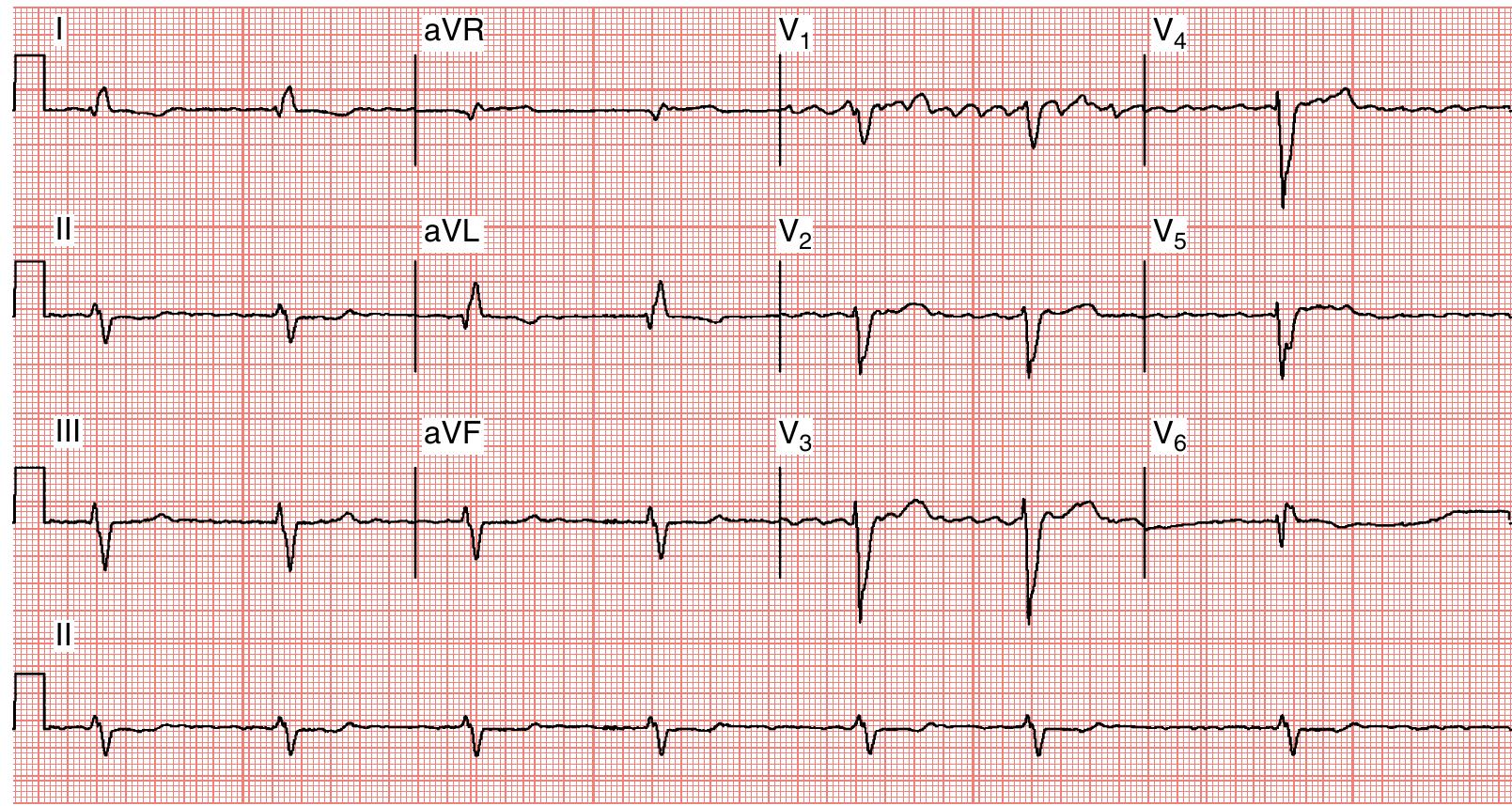 Atrial fibrillation with a slow ventricular response figure