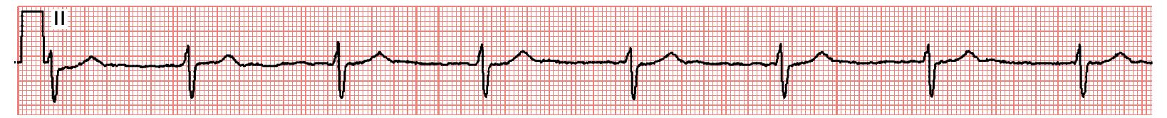 -11. complete atrioventricular (av) heart block (see chapter