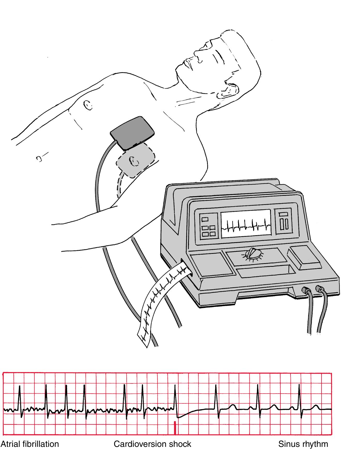 -13. direct current cardioversion (dccv) of atrial