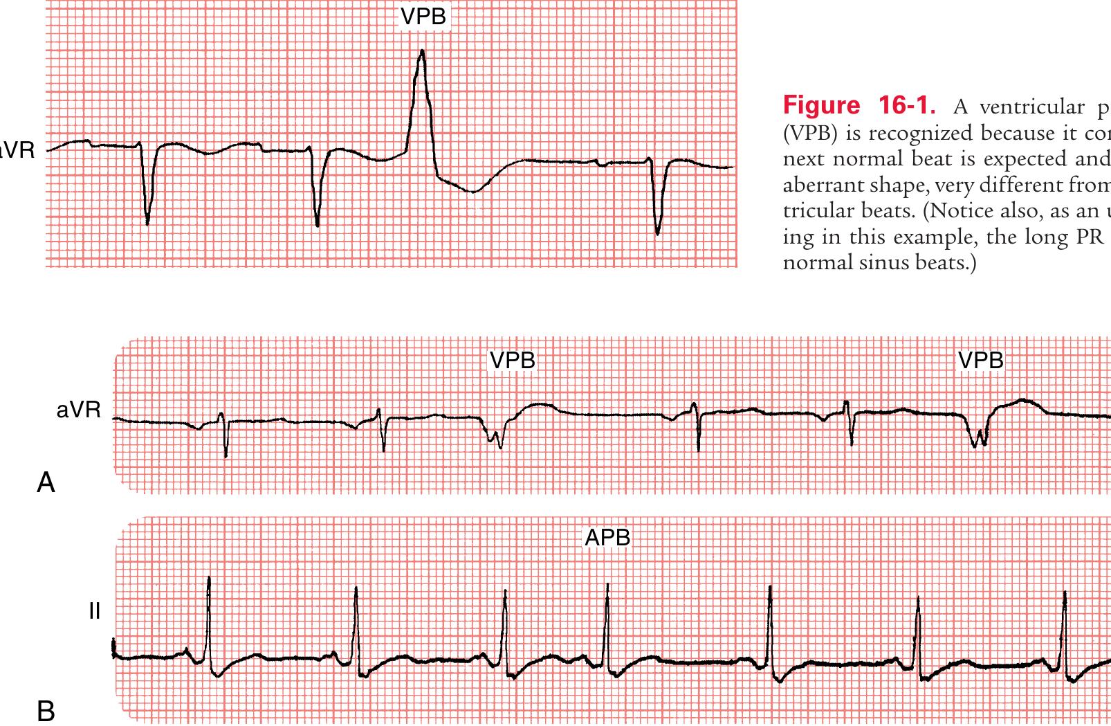 -2. notice the wide, aberrant shape of a ventricular