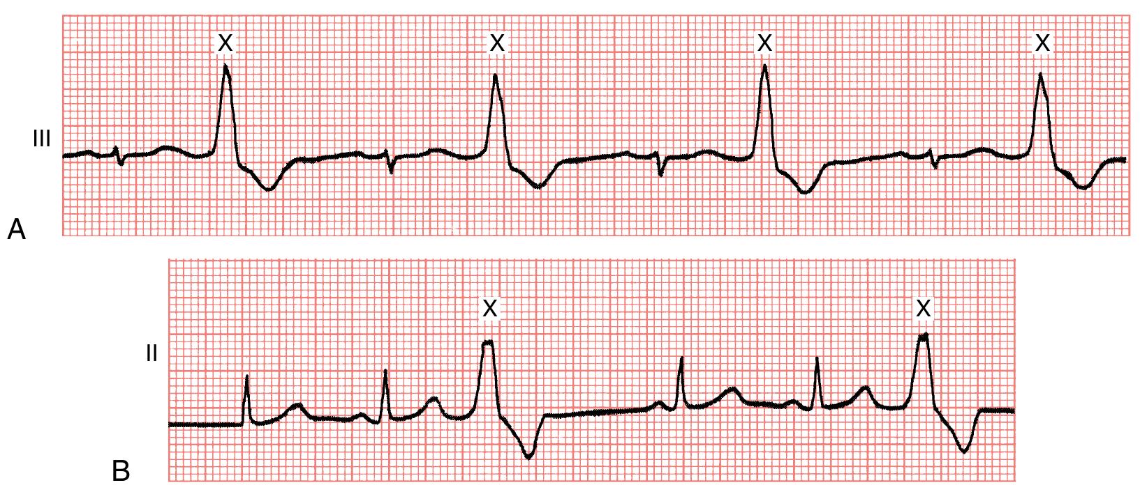 -6. a, ventricular bigeminy, in which each normal sinus