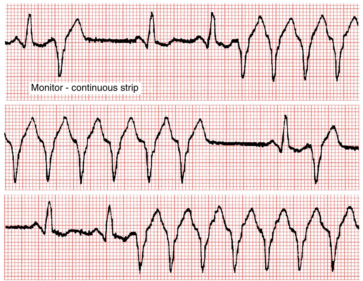 Paroxysmal nonsustained ventricular tachycardia