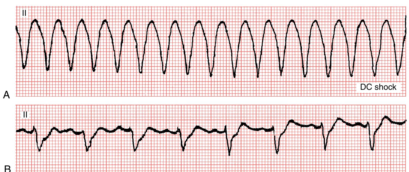 -14. a, long run of monomorphic ventricular tachycardia. b,