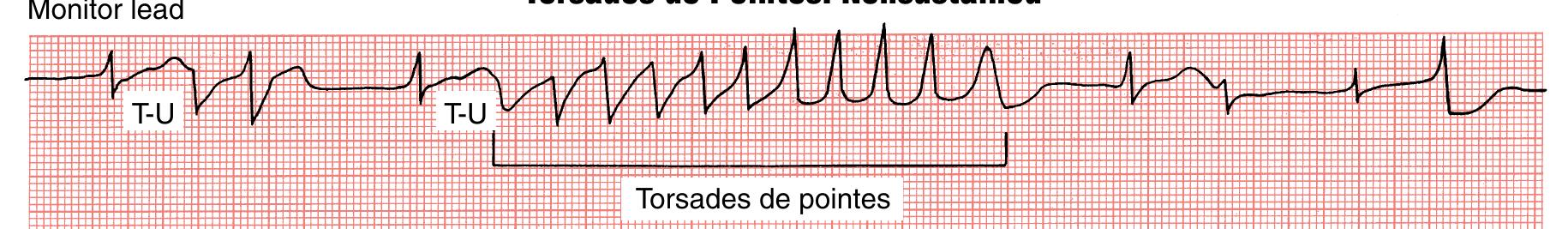-17. notice the shifting polarity and amplitude of the qrs