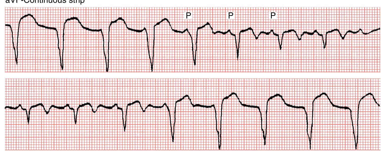 -20. accelerated idioventricular rhythm (aivr) in a patient
