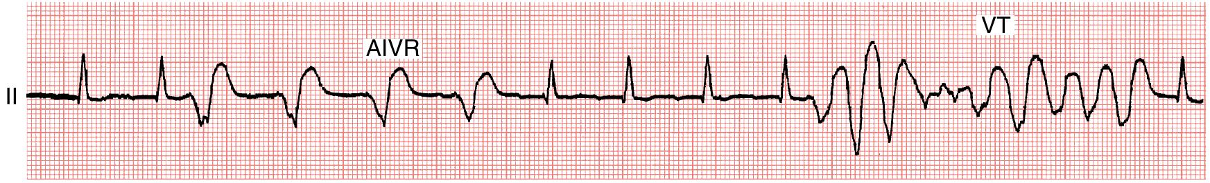 -21. accelerated idioventricular rhythm (aivr) and