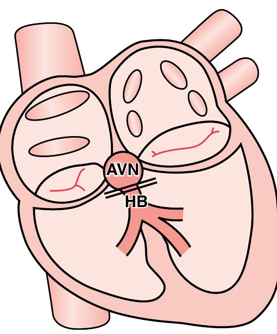 -1. nodal and infranodal blocks. schematic depicts the two