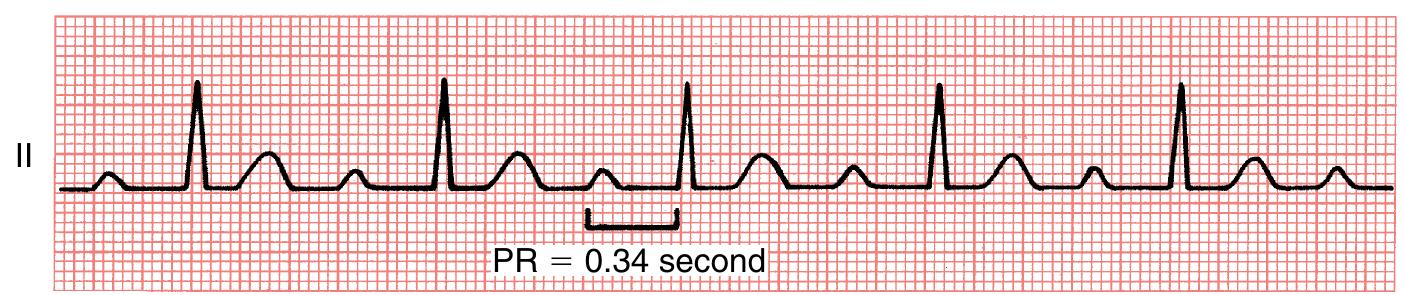 -2. with first-degree atrioventricular (av) “block,” the pr