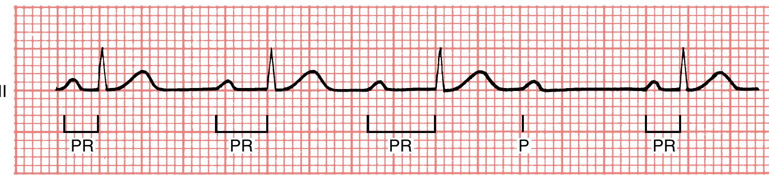 Mobitz type | (wenckebach) second-degree av block figure