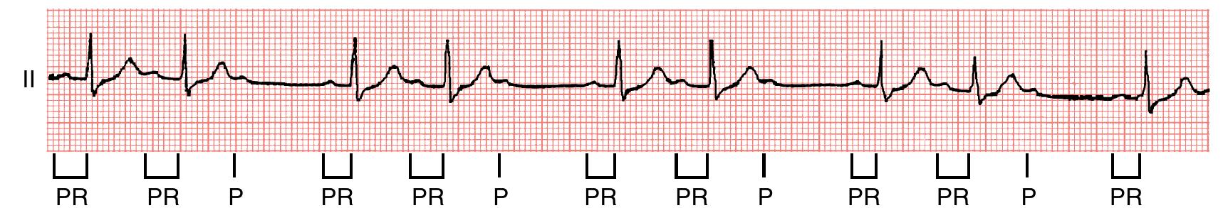 Mobitz type | (wenckebach) second-degree av block figure