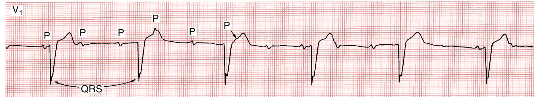 -8. this example of sinus rhythm with complete heart block