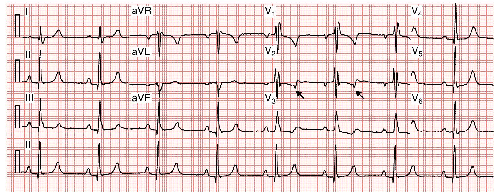 -10. sinus rhythm with 2:1 atrioventricular (av) block. in