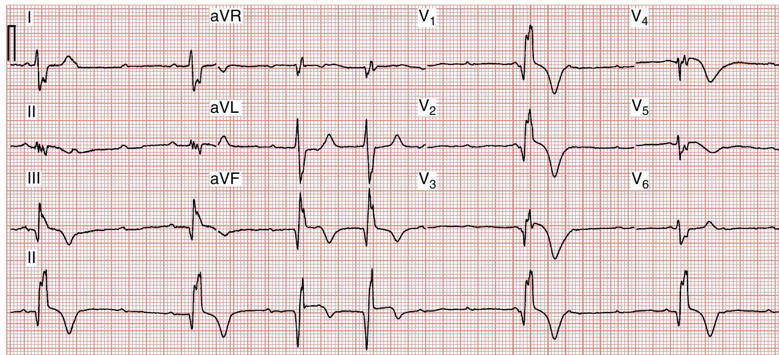 Acute/evolving anterior mi and av heart block figure 17-12.
