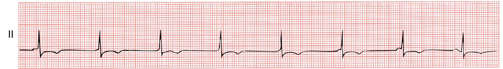 Isorhythmic av dissociation figure 17-14. this common type