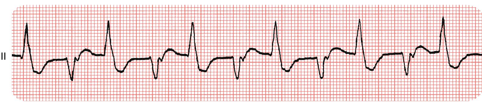 Bidirectional ventricular tachycardia figure 18-4. this