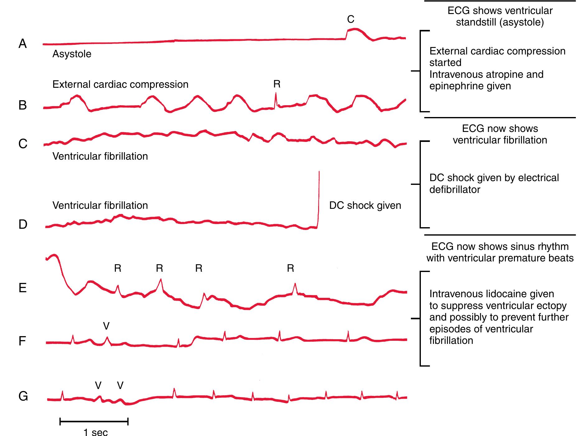 -6. ecg “history” of cardiac arrest and successful