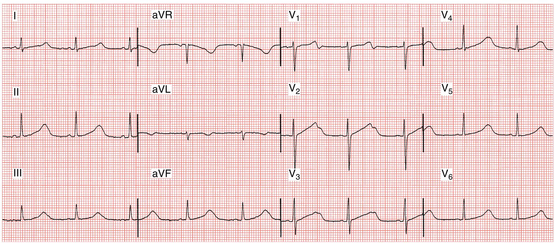 -8. hereditary long qt syndrome. ecg from 21-year-old woman