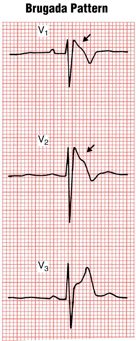 -9. brugada pattern showing characteristic st ele- vations