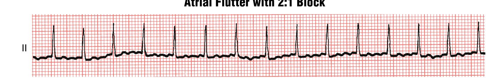 -7. atrial flutter with 2:1 atrioventricular (av) conduction