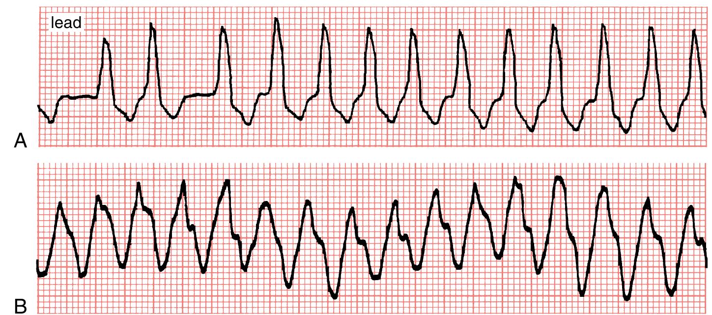 -9. a, atrial fibrillation with a left bundle branch block