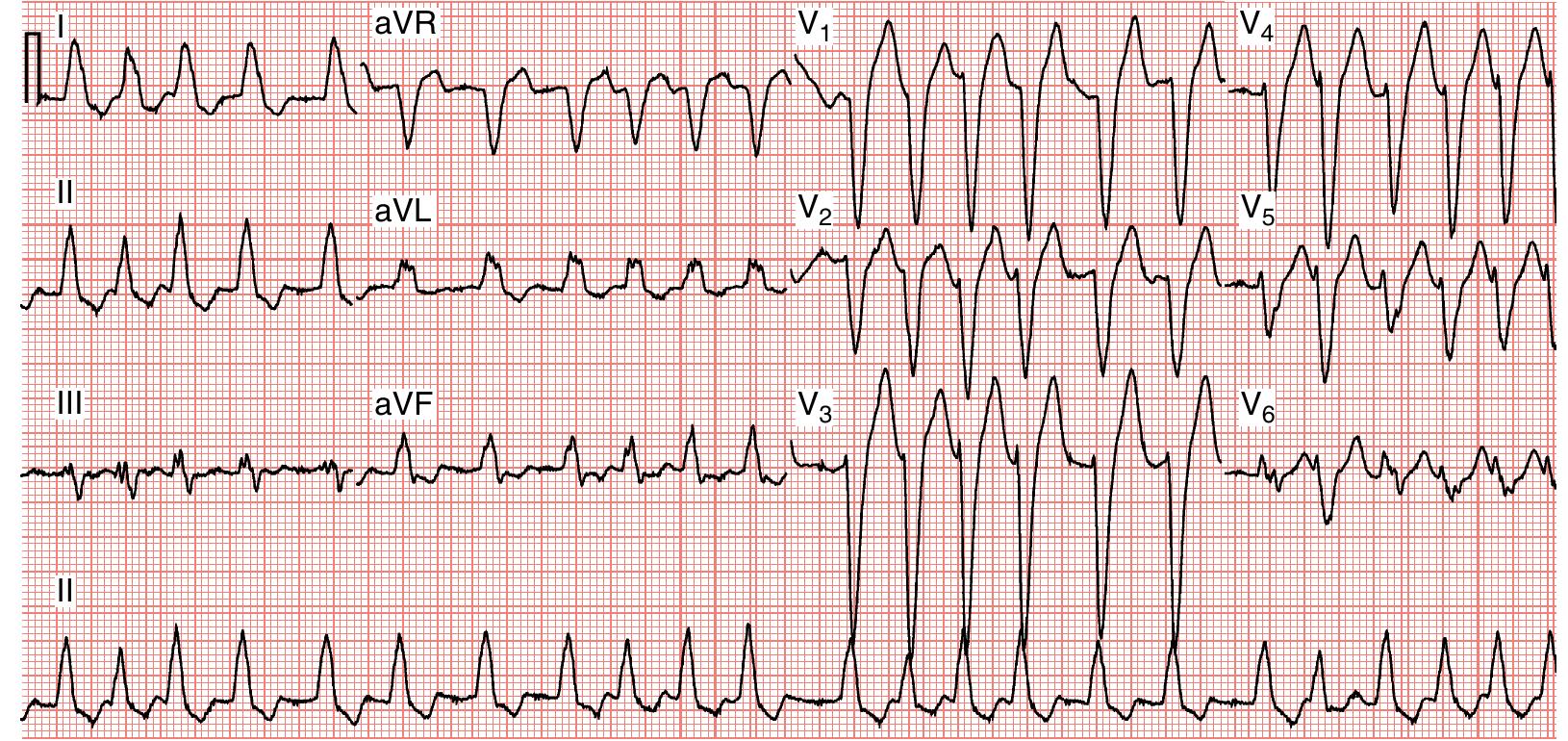 -10. the wide complex tachycardia (wct) is due to atrial