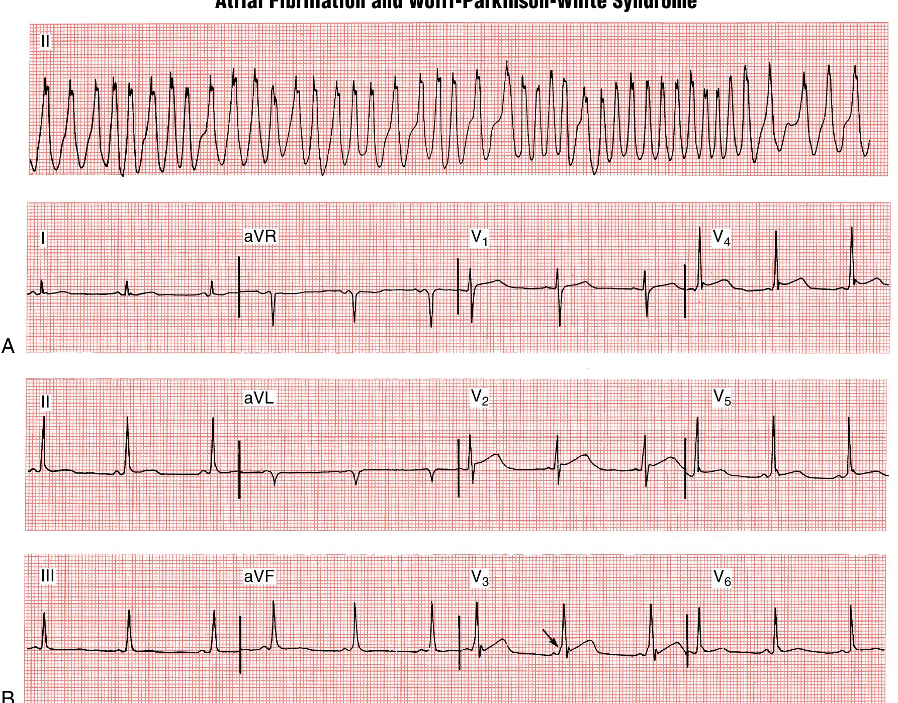 -11. a, atrial fibrillation with the wolff-parkinson-white
