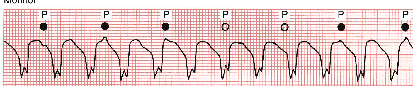 -12. sustained monomorphic ventricular tachycardia with