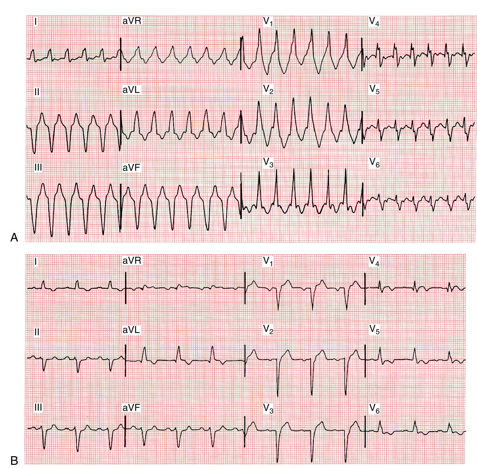 -13. sustained monomorphic ventricular tachycardia (vt) with