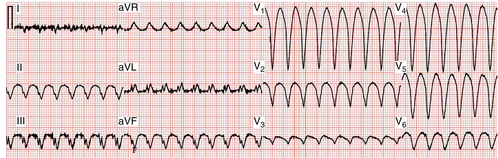 -15. monomorphic ventricular tachycardia (vt) with left