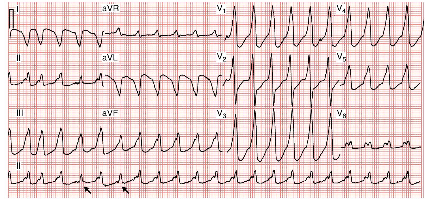 -16. positive concordance with monomorphic right bundle