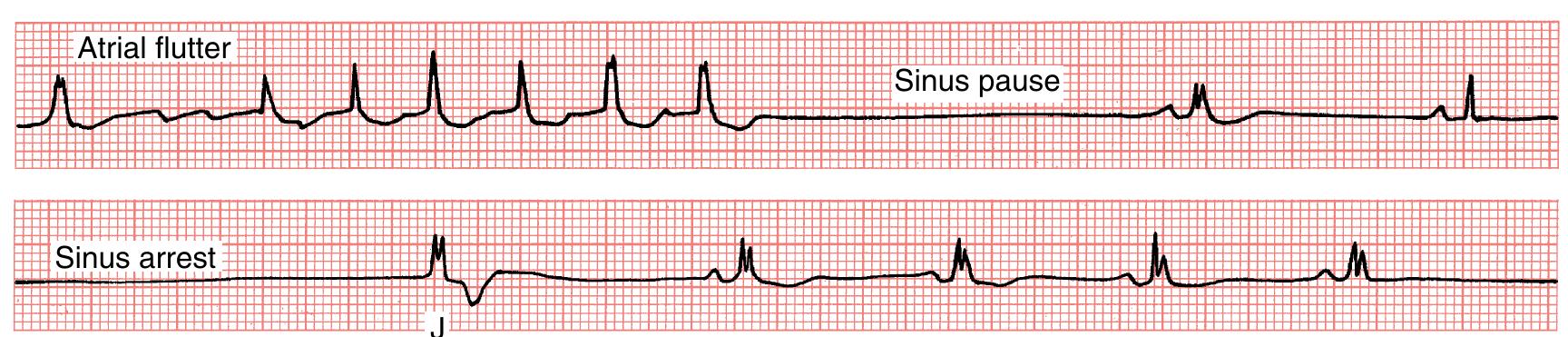 -17. brady-tachy (sick sinus) syndrome. this rhythm strip