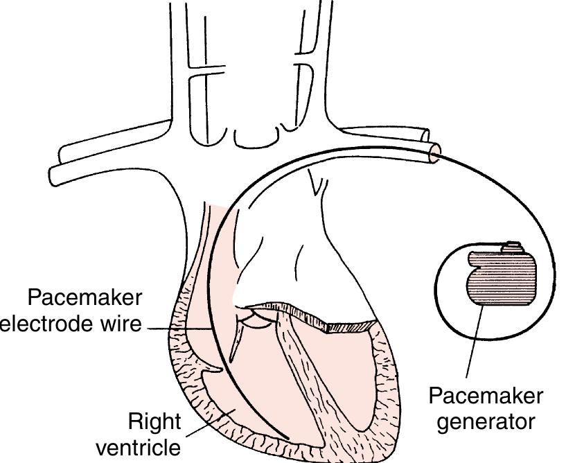 -1. schematic of an implanted pacemaker consist- ing of a