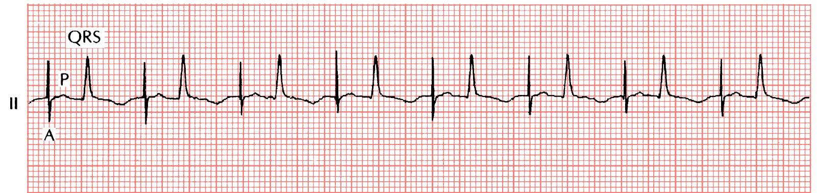 -2. with the pacemaker electrode placed in the right atrium,