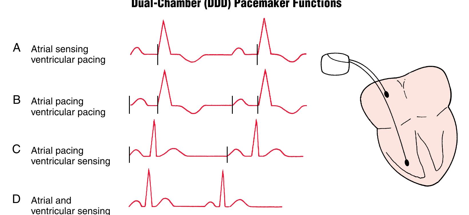 -4. dual-chamber (ddd) pacemakers sense and pace in both