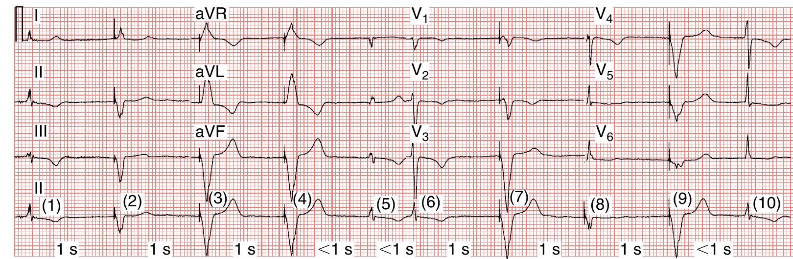 Ventricular demand pacing: intrinsic, fusion and fully paced