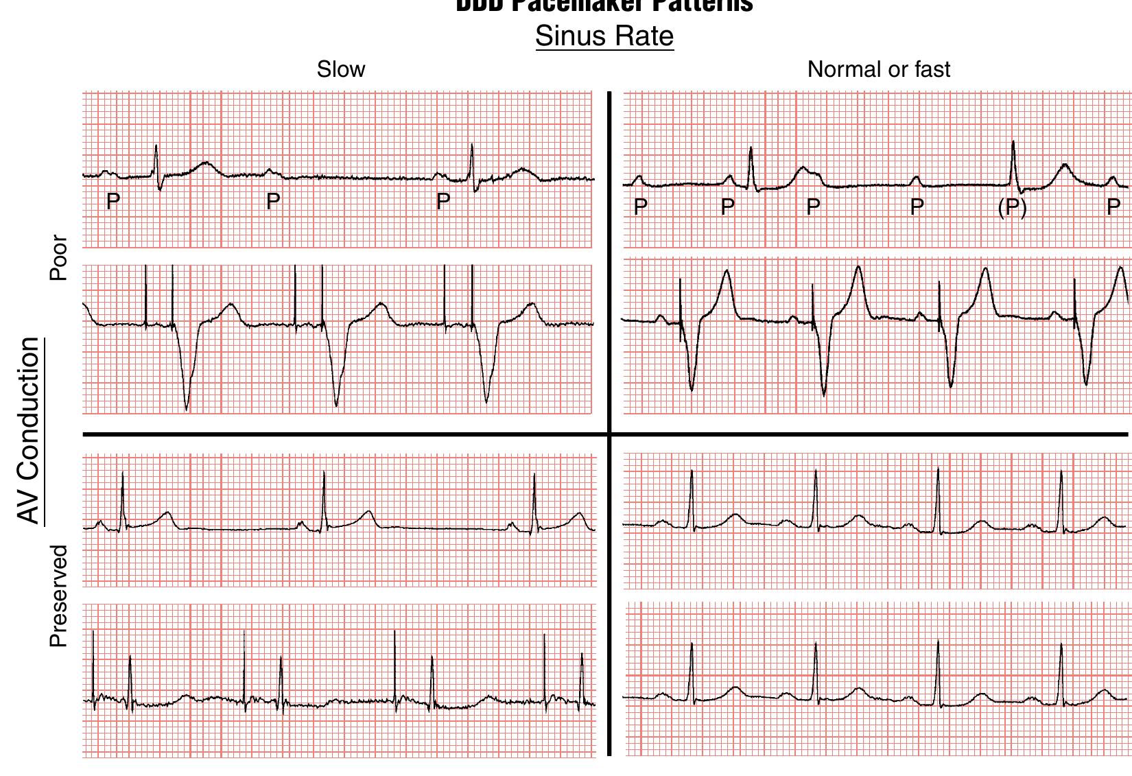Top panels (with "p" waves labeled): pacer “off” bottom